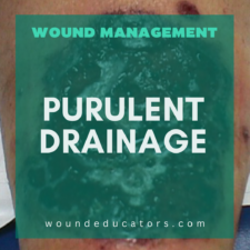 Purulent Drainage: Causes, Symptoms, And Treatment